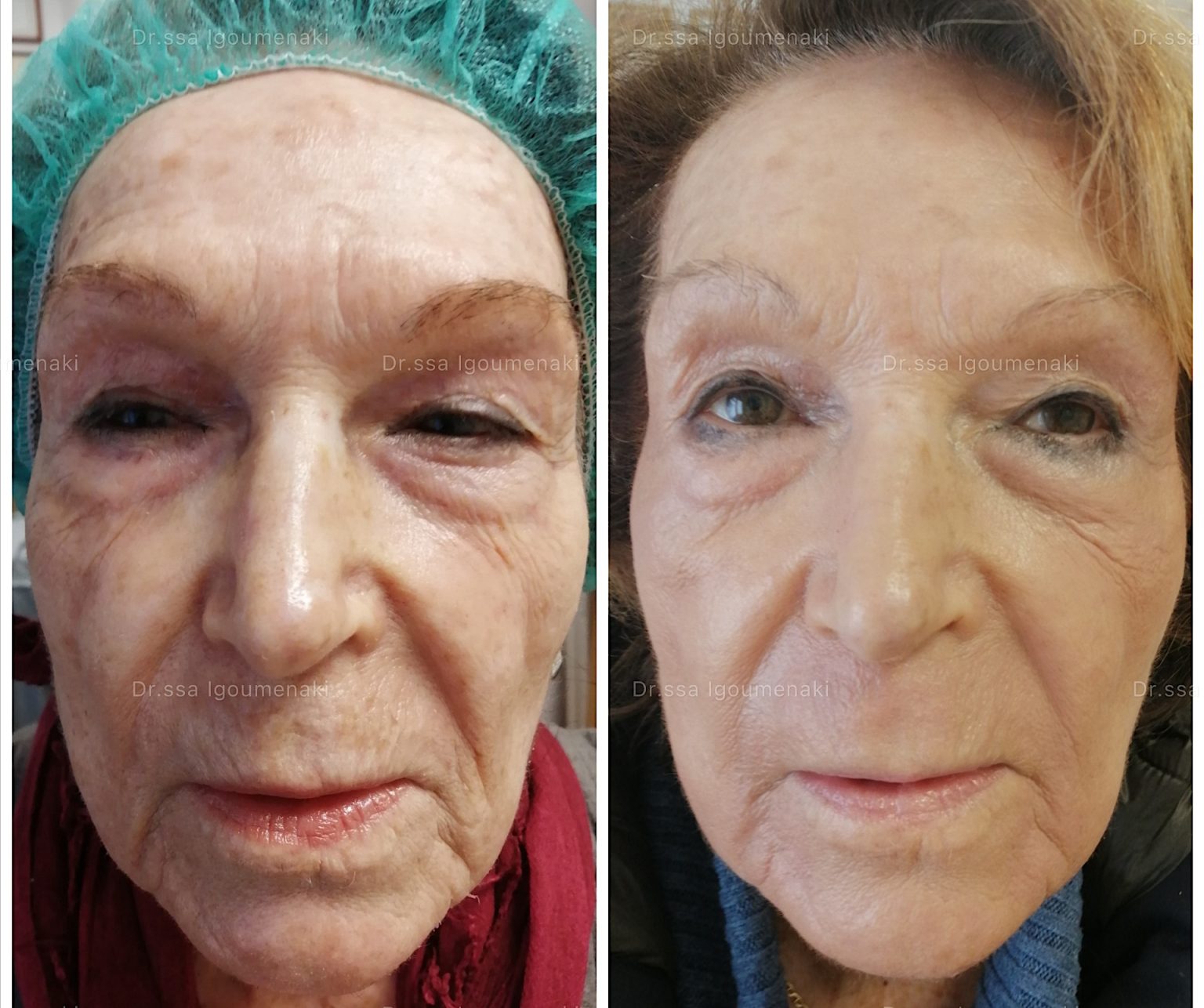 Blefaroplastica non chirurgica (palpebra inferiore e superiore) - Roma ...