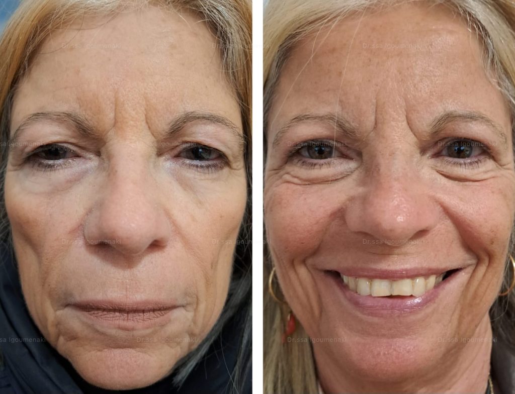 Blefaroplastica non chirurgica (palpebra inferiore e superiore) - Roma ...
