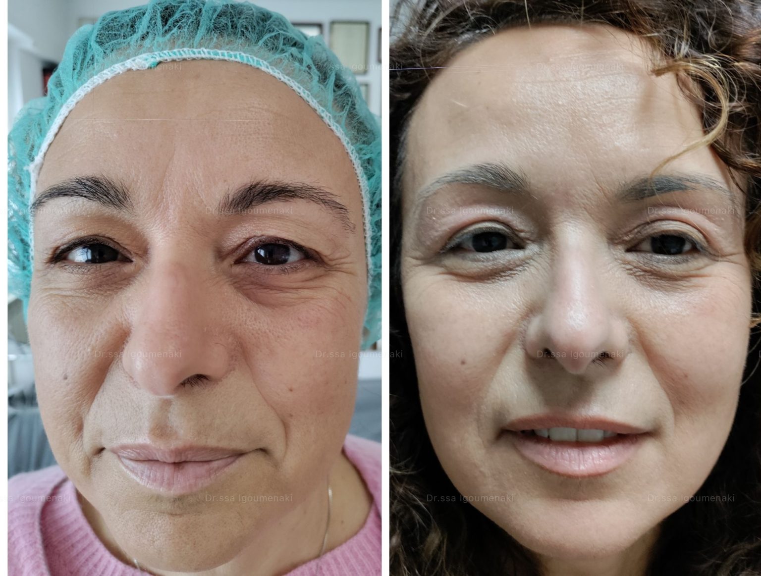 Blefaroplastica non chirurgica (palpebra inferiore e superiore) - Roma ...
