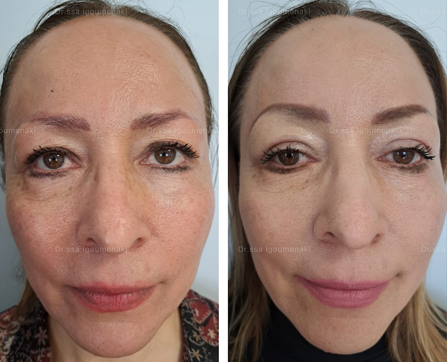 Blefaroplastica non chirurgica (palpebra inferiore e superiore) - Roma ...