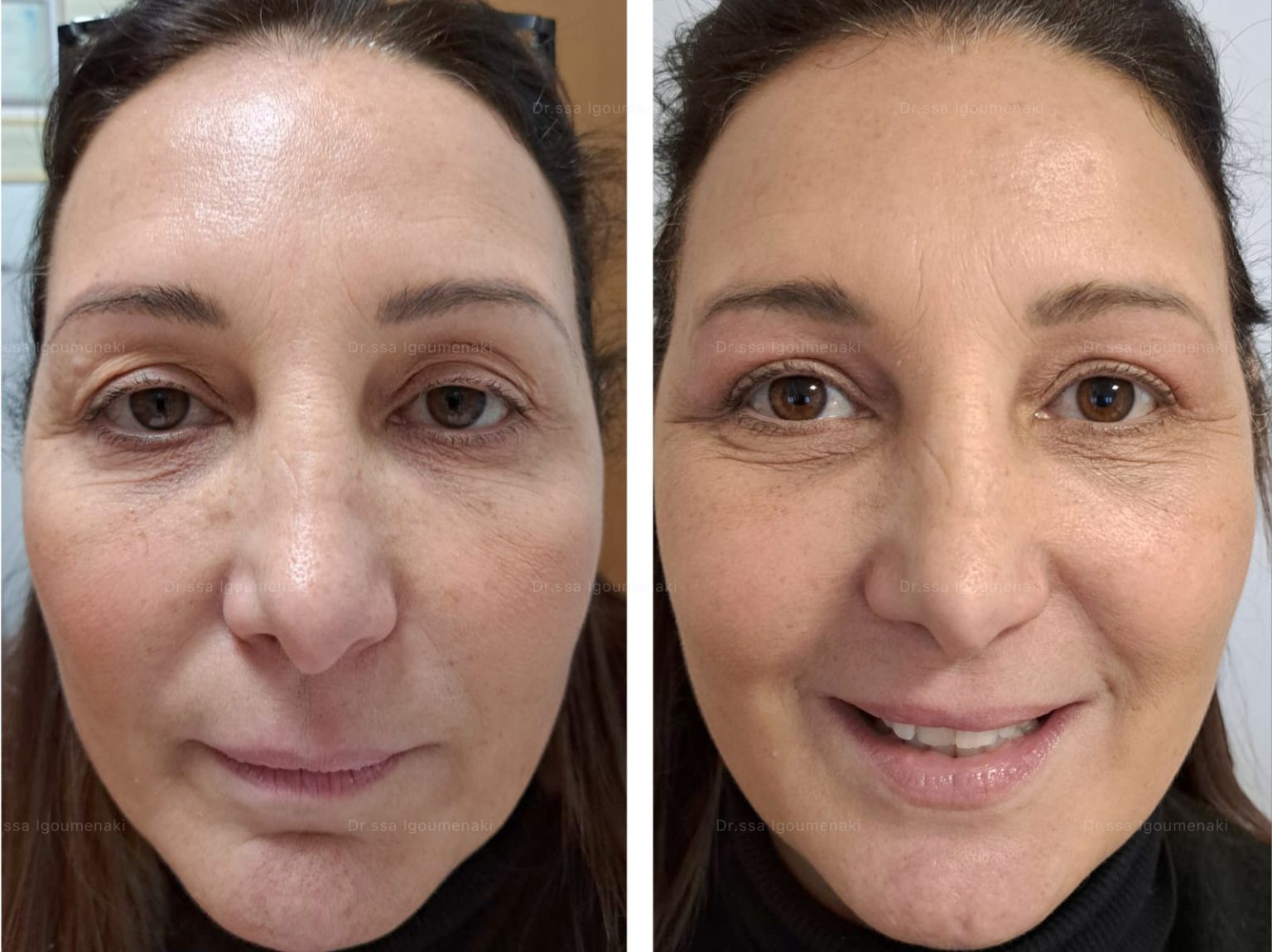 Blefaroplastica non chirurgica (palpebra inferiore e superiore) - Roma ...