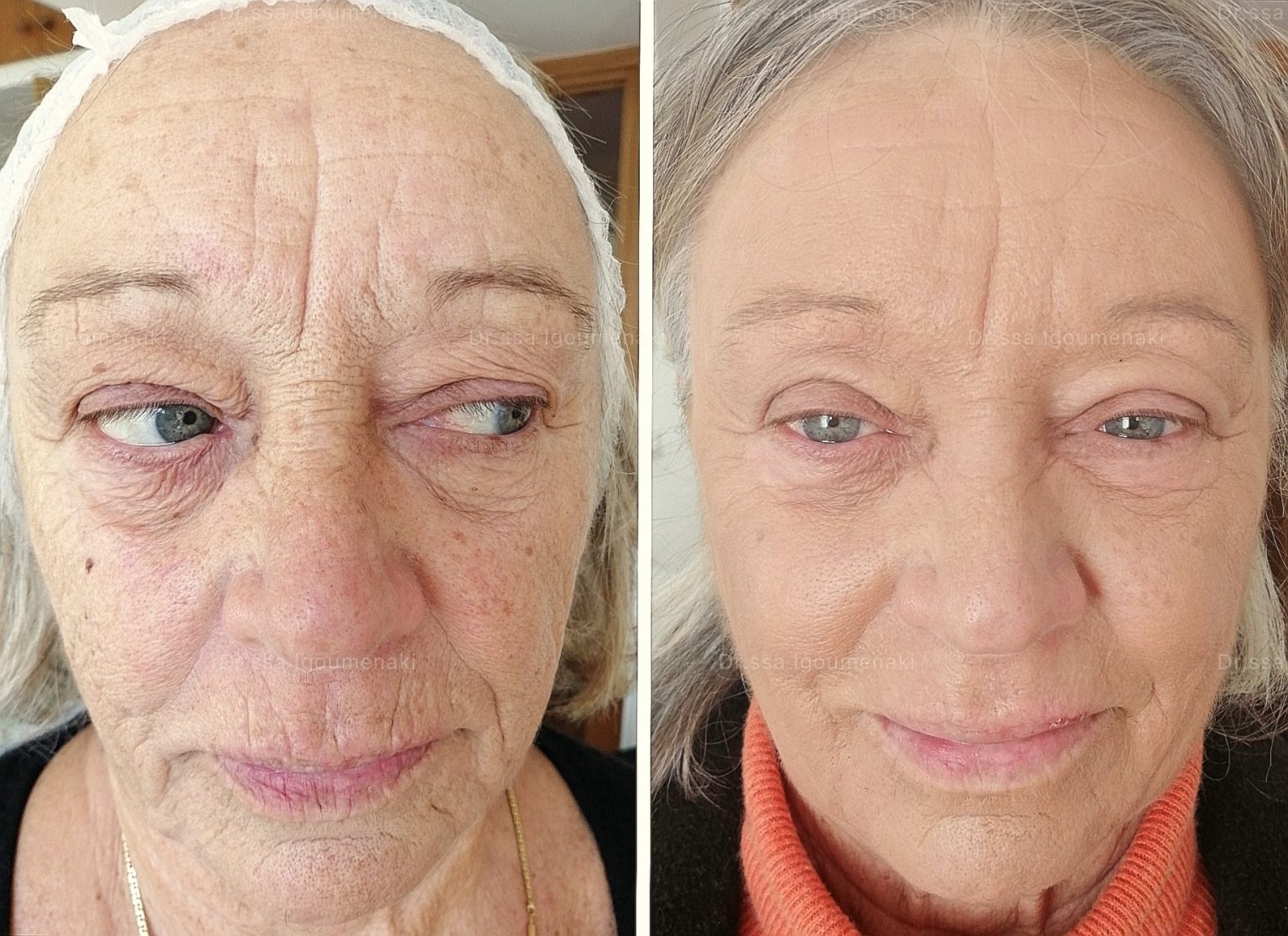 Blefaroplastica non chirurgica (palpebra inferiore e superiore) - Roma ...