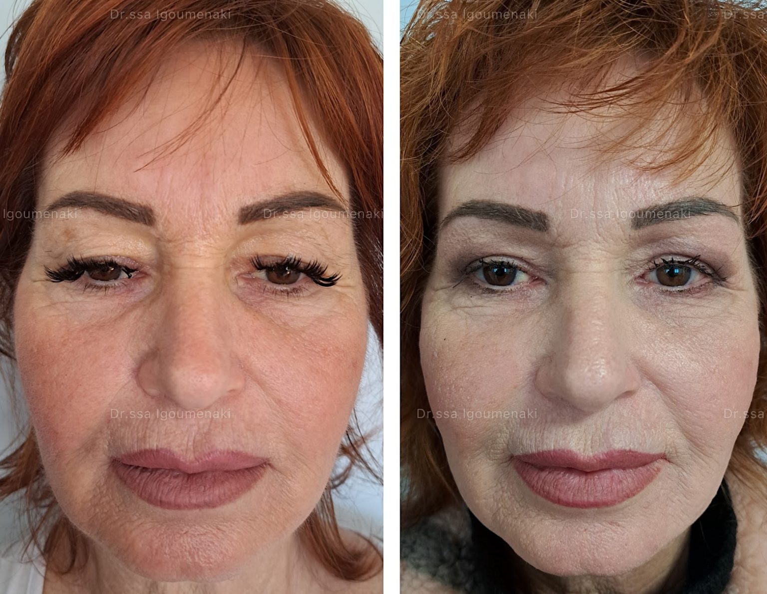 Blefaroplastica non chirurgica (palpebra inferiore e superiore) - Roma ...