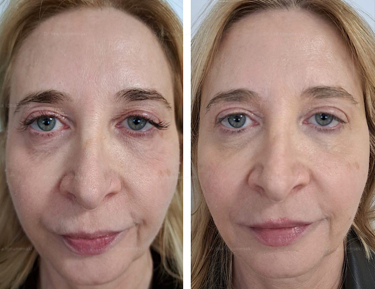 Blefaroplastica non chirurgica (palpebra inferiore e superiore) - Roma ...
