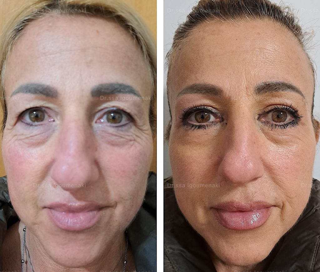 Blefaroplastica non chirurgica (palpebra inferiore e superiore) - Roma ...
