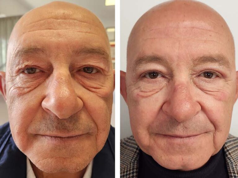 Blefaroplastica non chirurgica (palpebra inferiore e superiore) - Roma ...