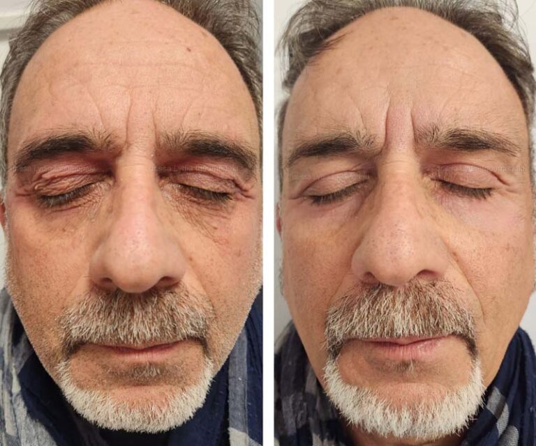 Blefaroplastica non chirurgica (palpebra inferiore e superiore) - Roma ...