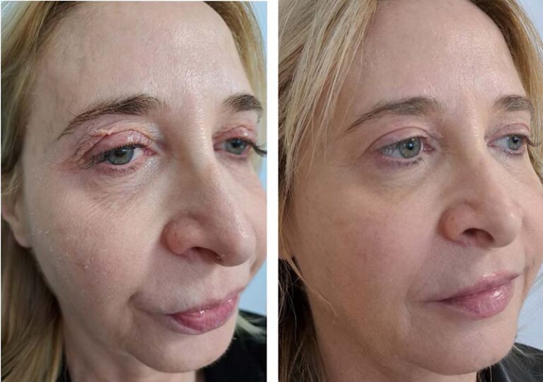 Blefaroplastica non chirurgica (palpebra inferiore e superiore) - Roma ...