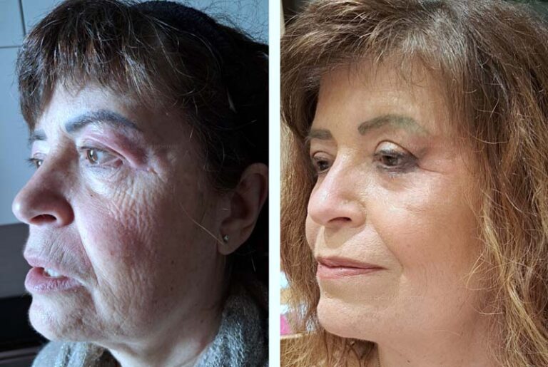 Blefaroplastica non chirurgica (palpebra inferiore e superiore) - Roma ...