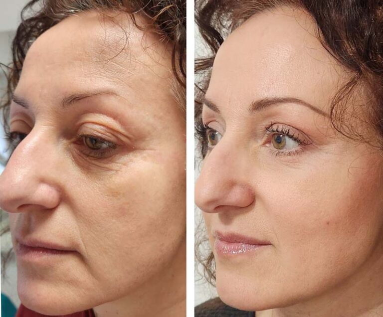 Blefaroplastica non chirurgica (palpebra inferiore e superiore) - Roma ...