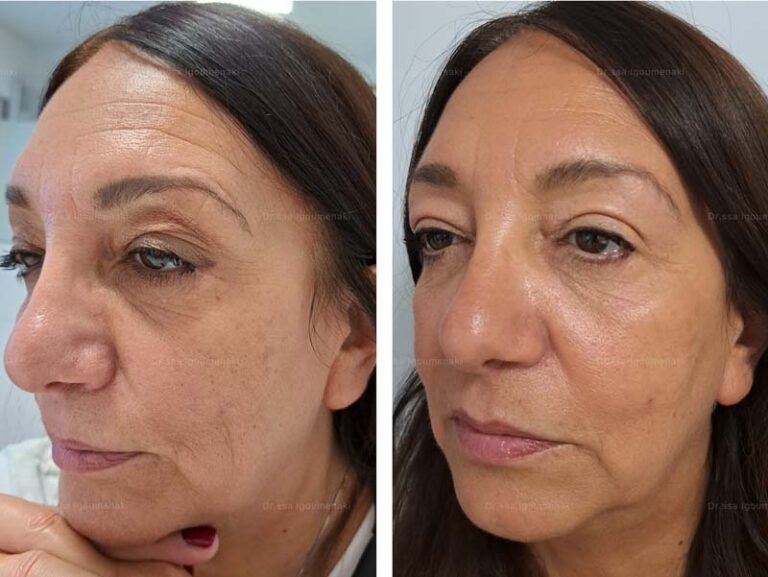 Blefaroplastica non chirurgica (palpebra inferiore e superiore) - Roma ...