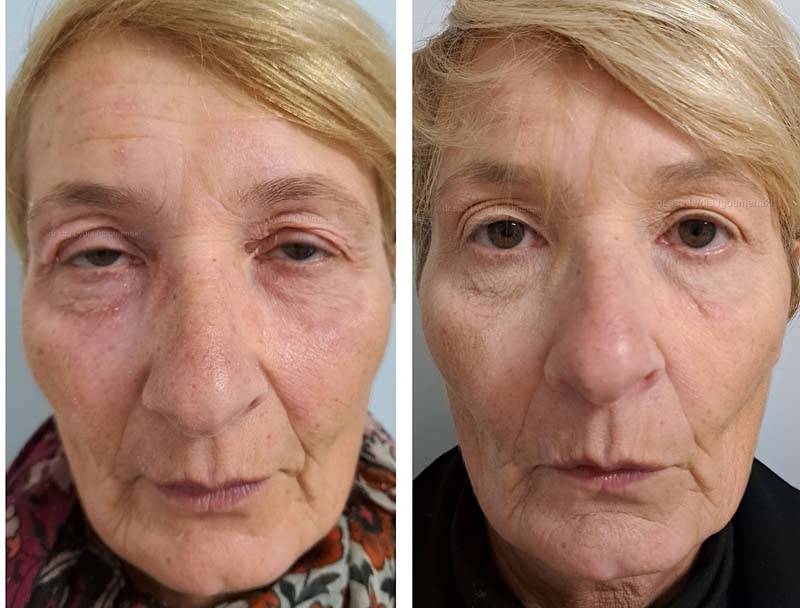 Blefaroplastica non chirurgica (palpebra inferiore e superiore) - Roma ...