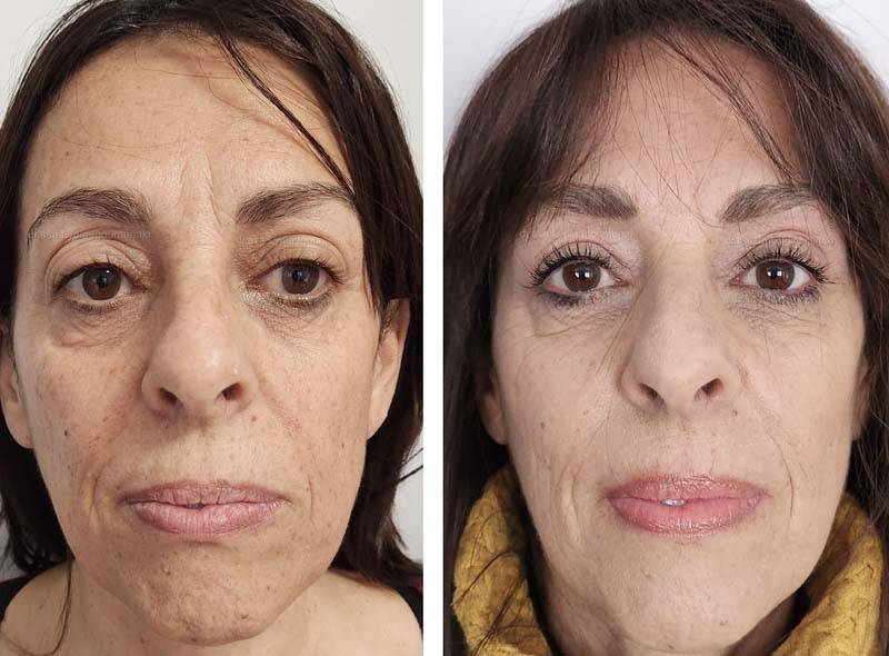 Blefaroplastica non chirurgica (palpebra inferiore e superiore) - Roma ...